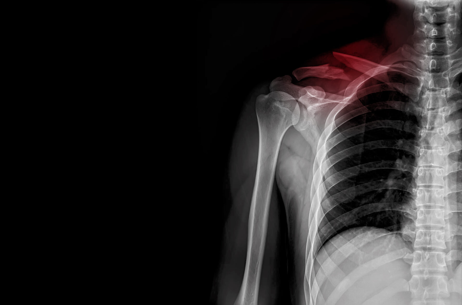 Effective Home Exercises After Rotator Cuff Surgery - MedAmerica ...